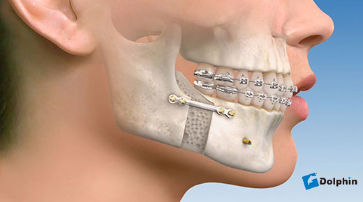 Ortognátní chirurgie: operace čelistních vad | DENT CLINIC s.r.o.